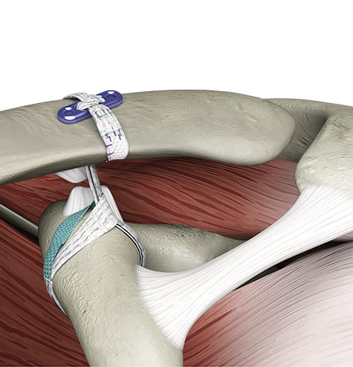 Acromioclavicular Joint (ACJ) - Xiros
